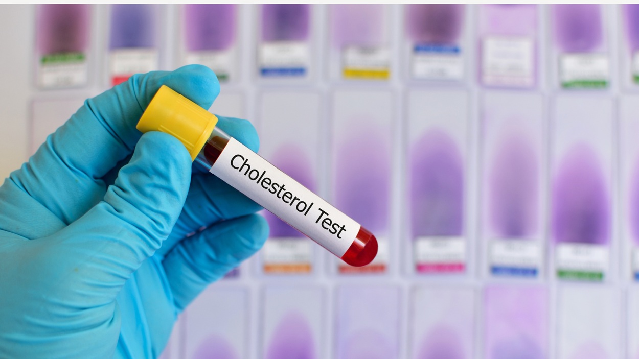 Why Your “Normal” Cholesterol Panel May Be Lying to You - James Clinic